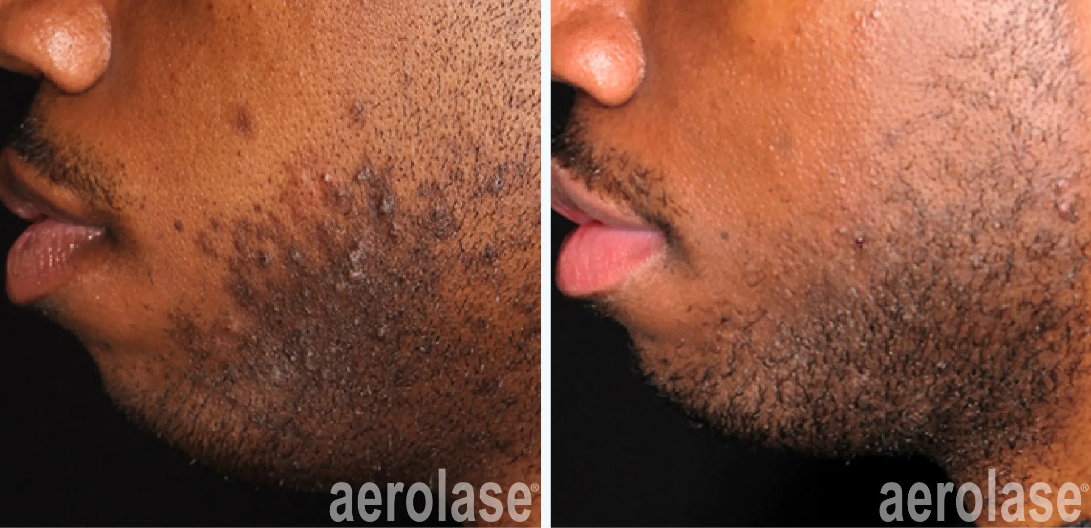 Melasma – Envy Aesthetics – Expert Botox, Fillers & Laser Skin Treatments